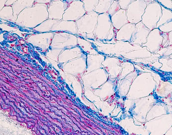 Aortic Dissection Claims News & Insights | Fieldfisher