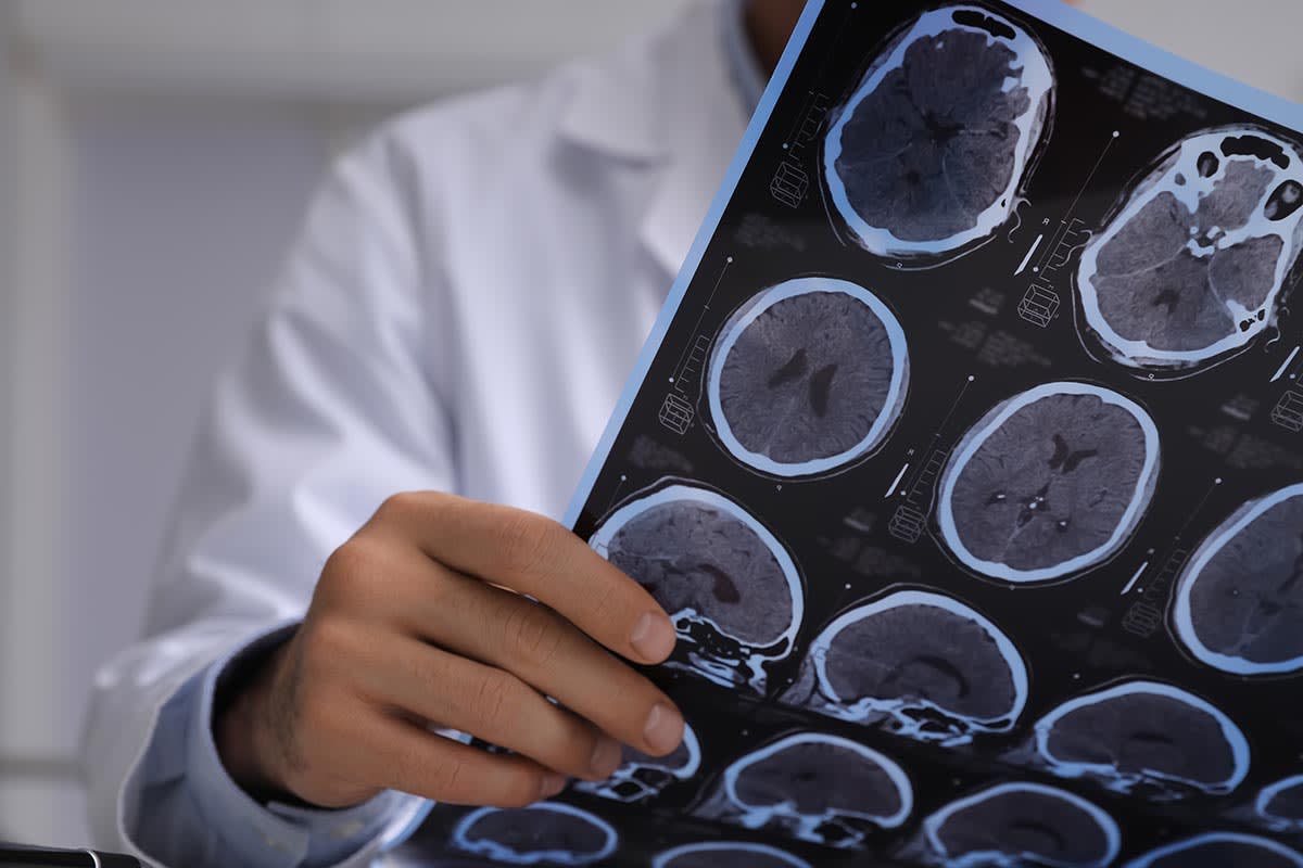 New NICE guidelines around early management of head injury should ...